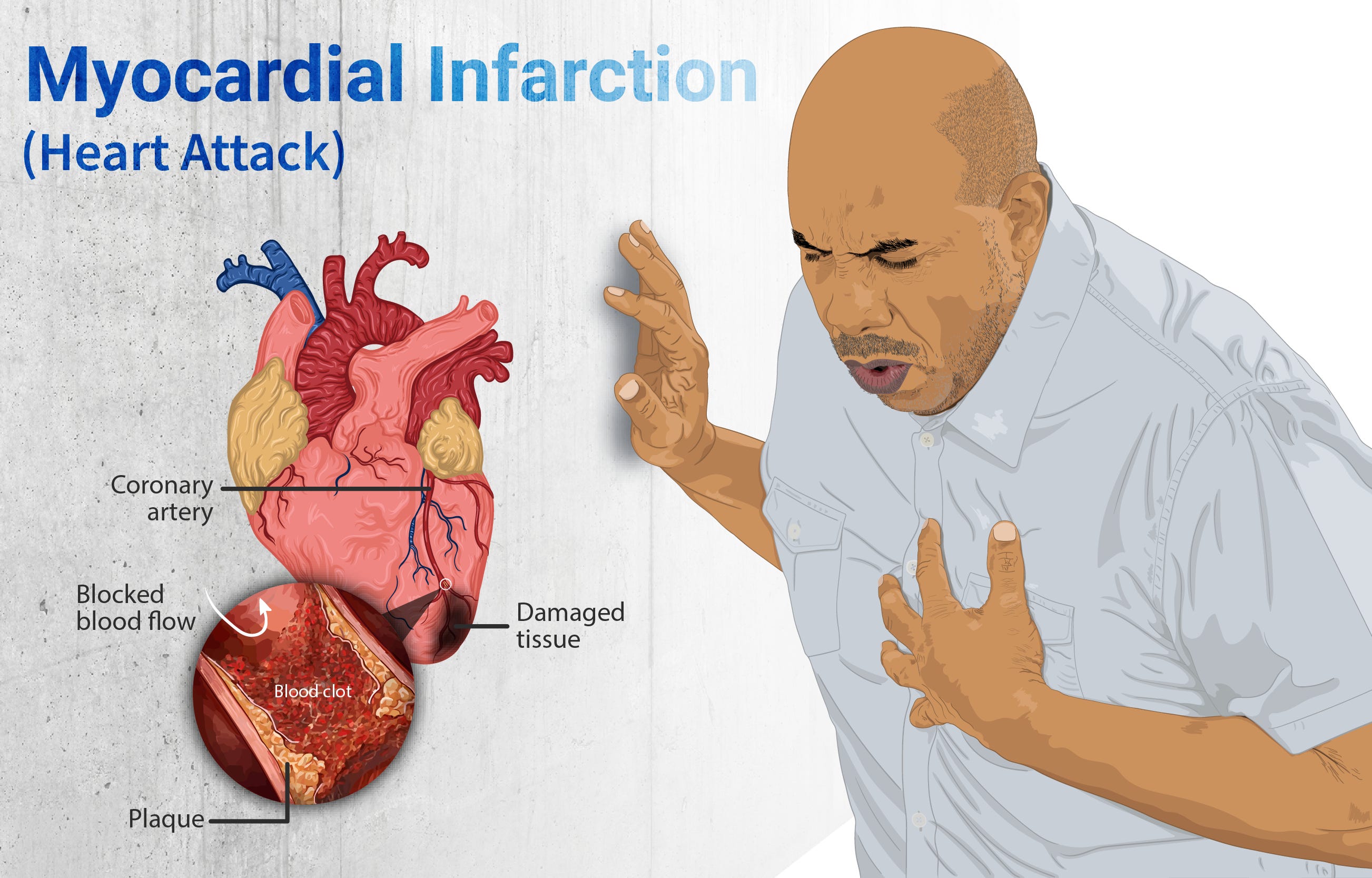 Early Warning Symptoms Of A Heart Attack