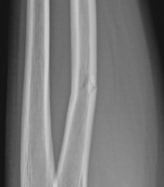 Fractures, fractures and more fractures - by Habib Mahdi