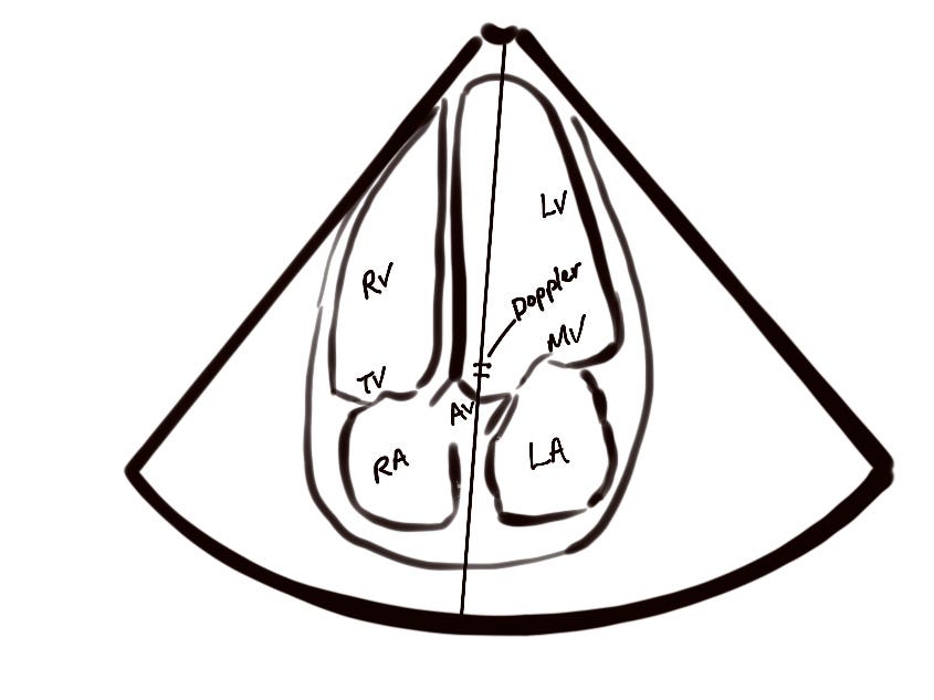 What is VTI? - by Scott Biggerstaff - POCUS.pizza