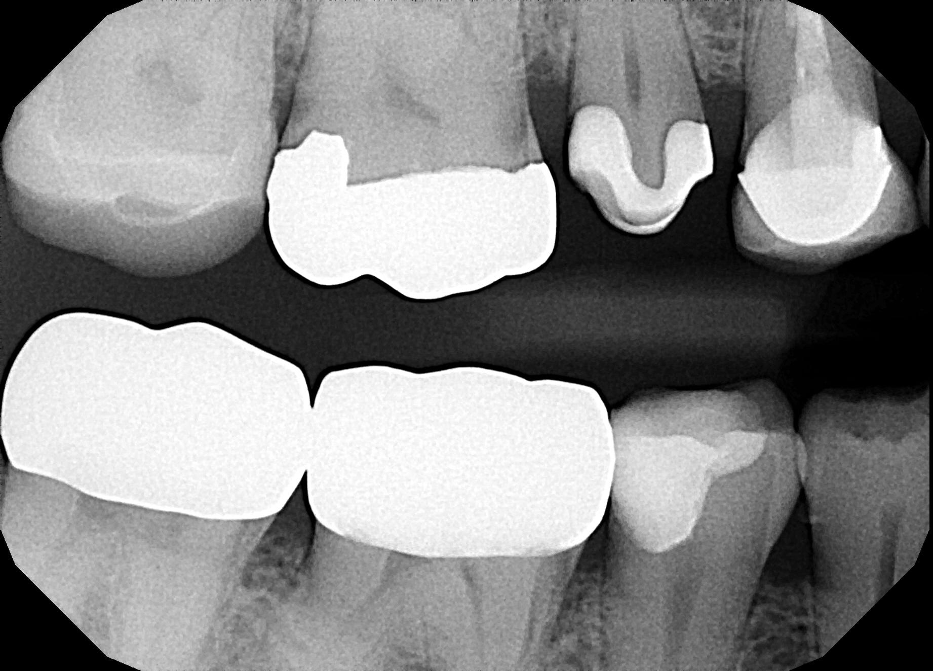 The "Liquid Dam" Technique - by Brandon Walker, D.D.S.
