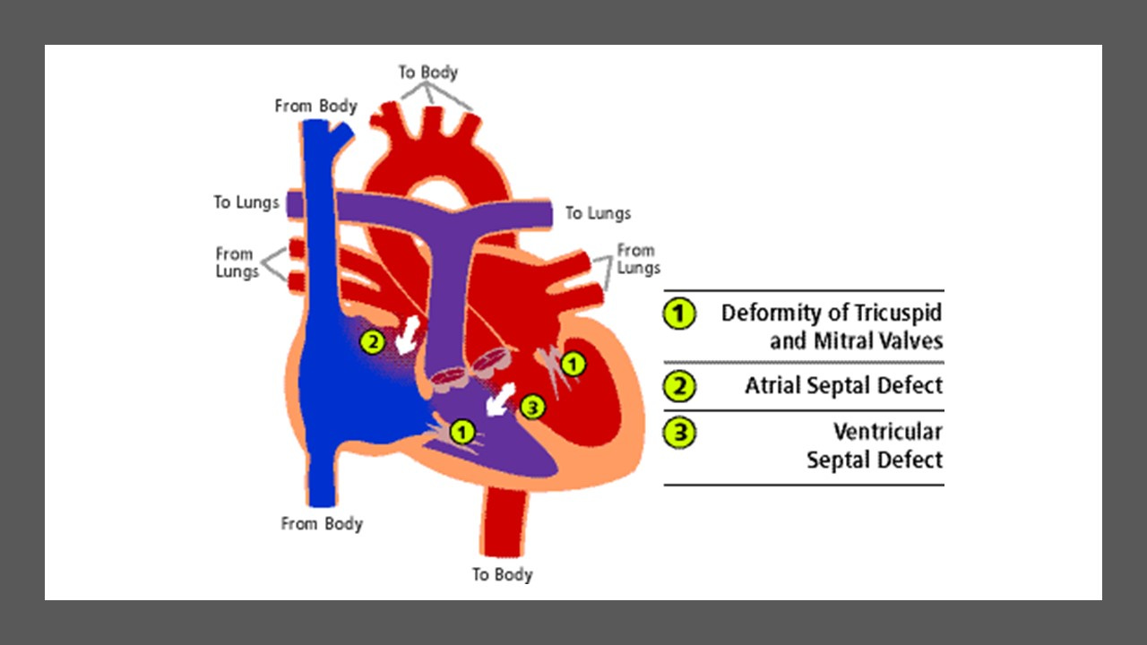 COMPLETE AV CANAL (CAVC) DEFECT - by Vikas Kohli