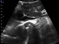 Inspiratory collapse of the inferior vena cava: What is it telling us?