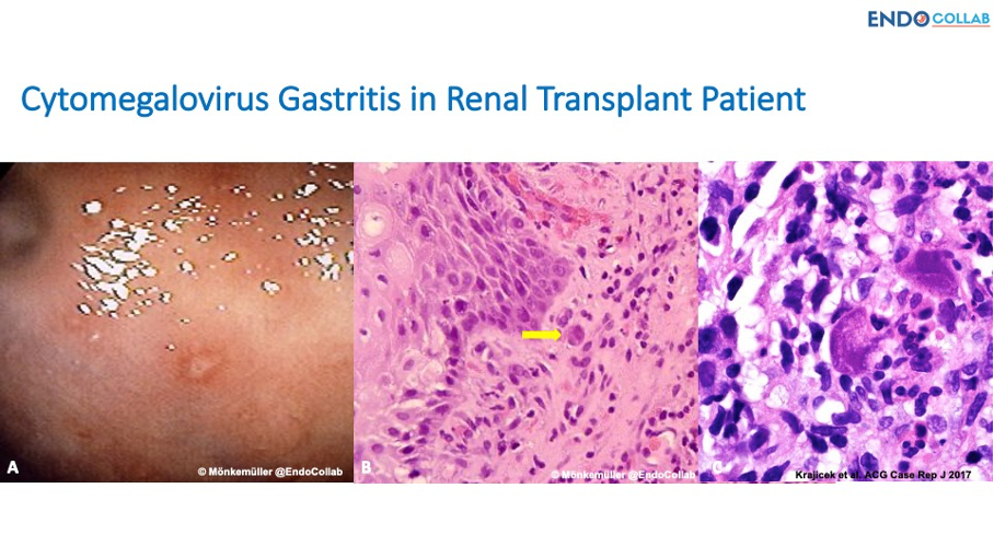 Cytomegalovirus (CMV) Gastritis - by Klaus Mönkemüller