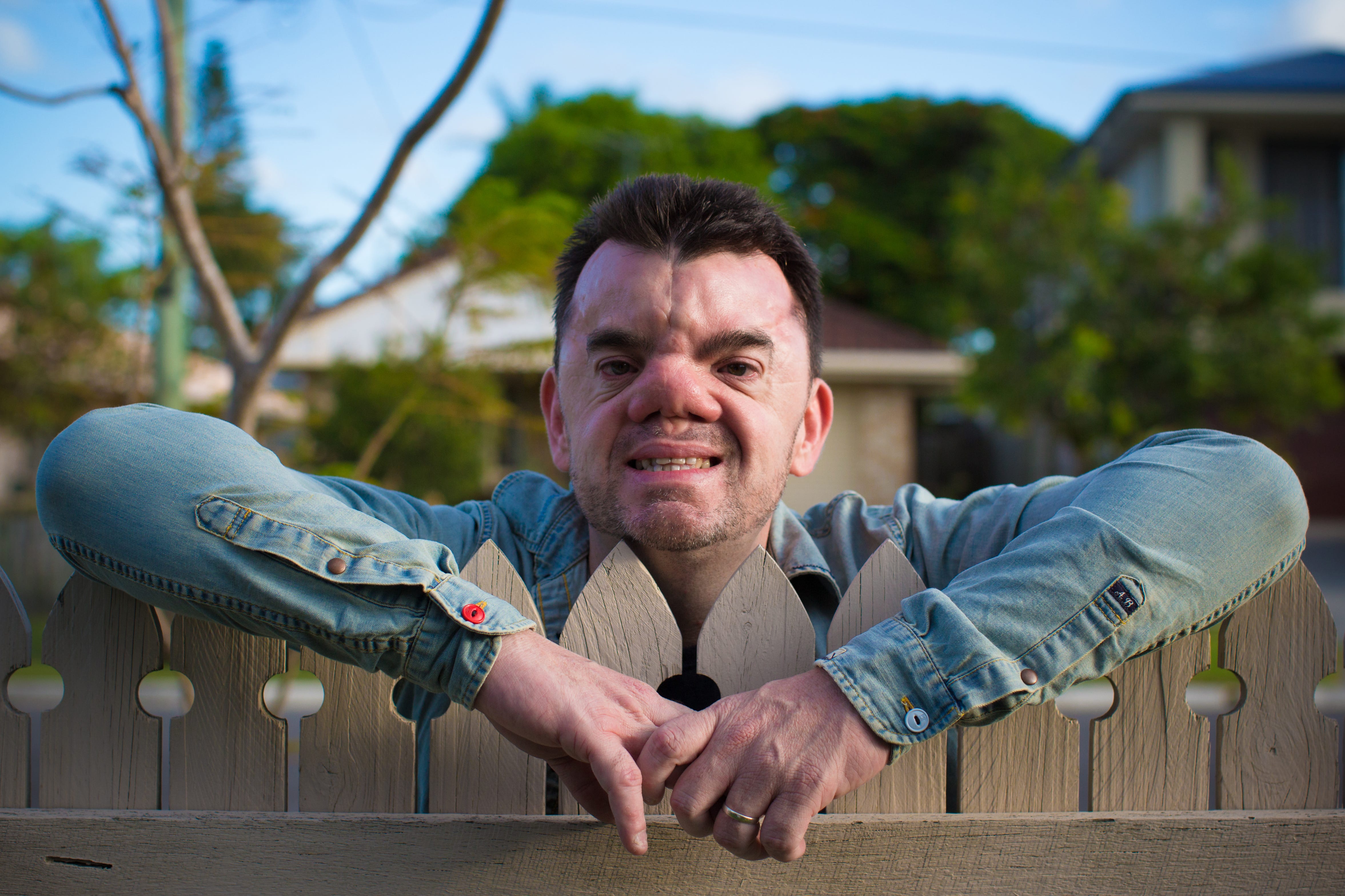 The Profile Original: Meet Robert Hoge, the ‘Ugly’ Human Living a ...