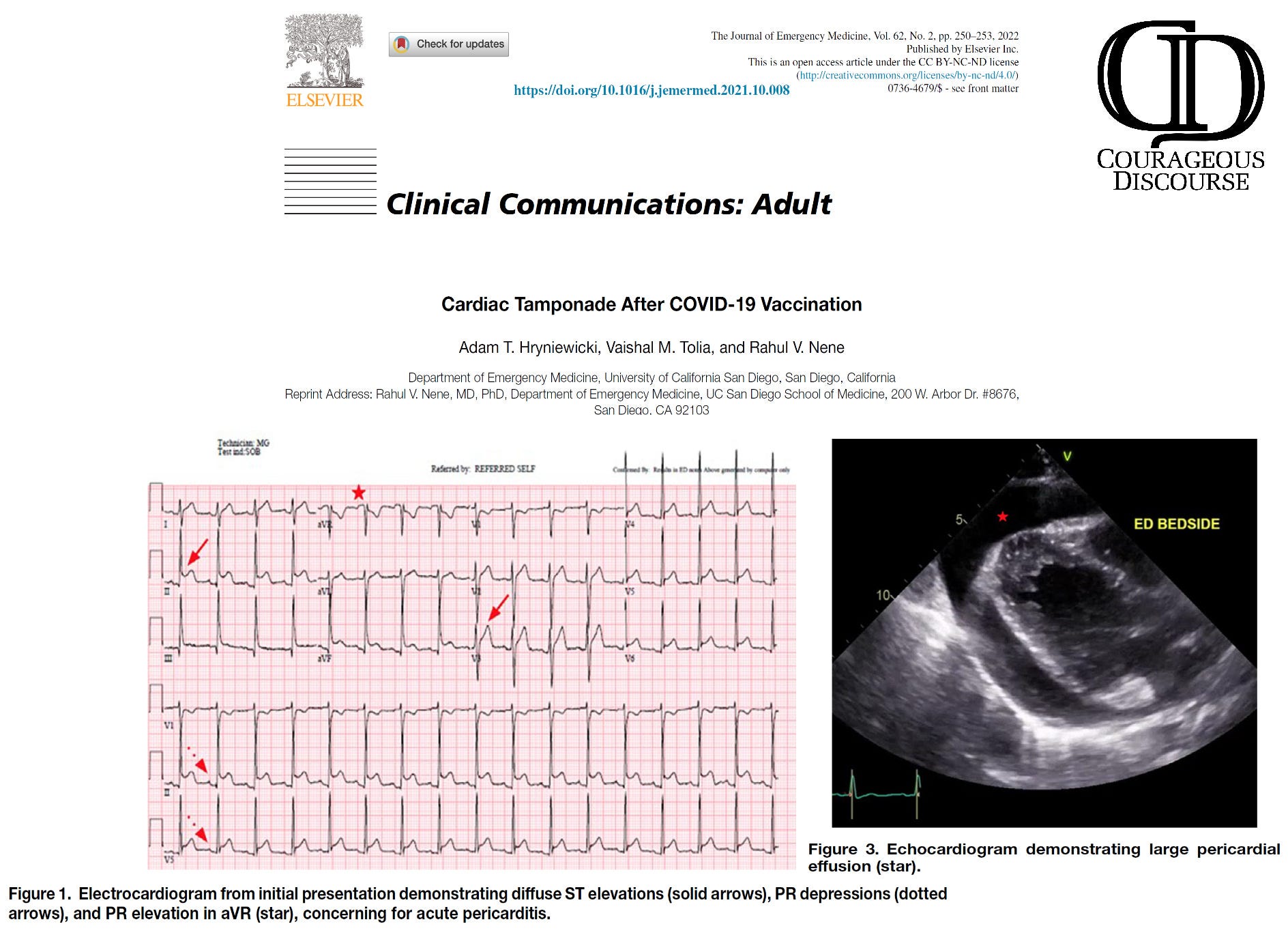 Καρδιακός επιπωματισμός μετά τον εμβολιασμό κατά της COVID-19