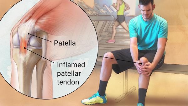 Patellar tendinopathy rehab: Is progressive loading therapy or ...