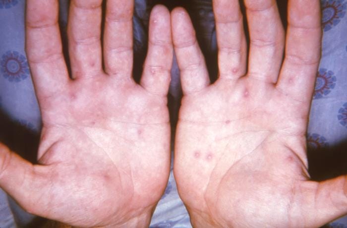 Varicella Chickenpox Immunisation Advisory Centre