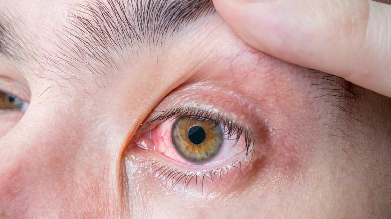 One in Three People Has This Eye Parasite