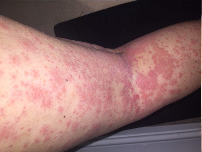 Μια Νέα Βακτηριακή Ασθένεια; Όχι, Είναι Απλά Περισσότερη Κινδυνολογία