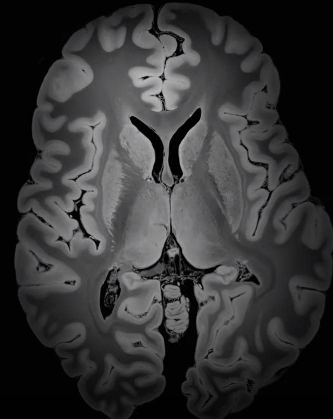 INSIGHTS | 20. The Link Between Autism & Inflammation