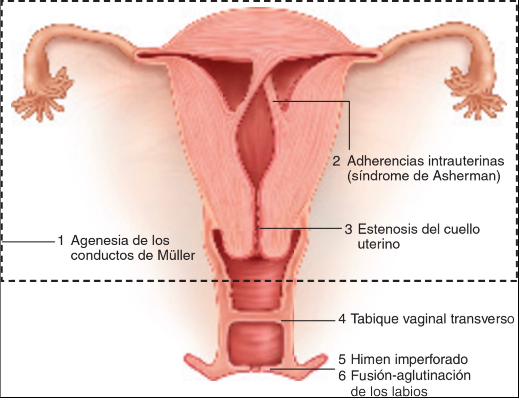Amenorrea - by Harold Ferraz - Medical Student