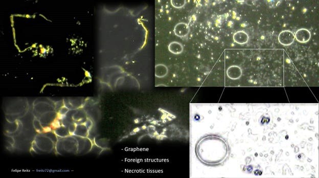 Computerized Thermographic Imaging and Live Blood Analysis Post C19 ...