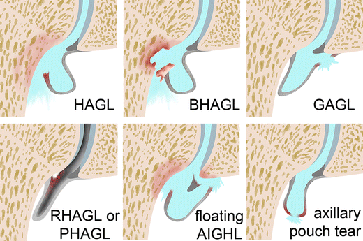 TEARS AROUND THE GLENOMUMERAL LIGAMENT…OR HAGLs, GAGLs and the like