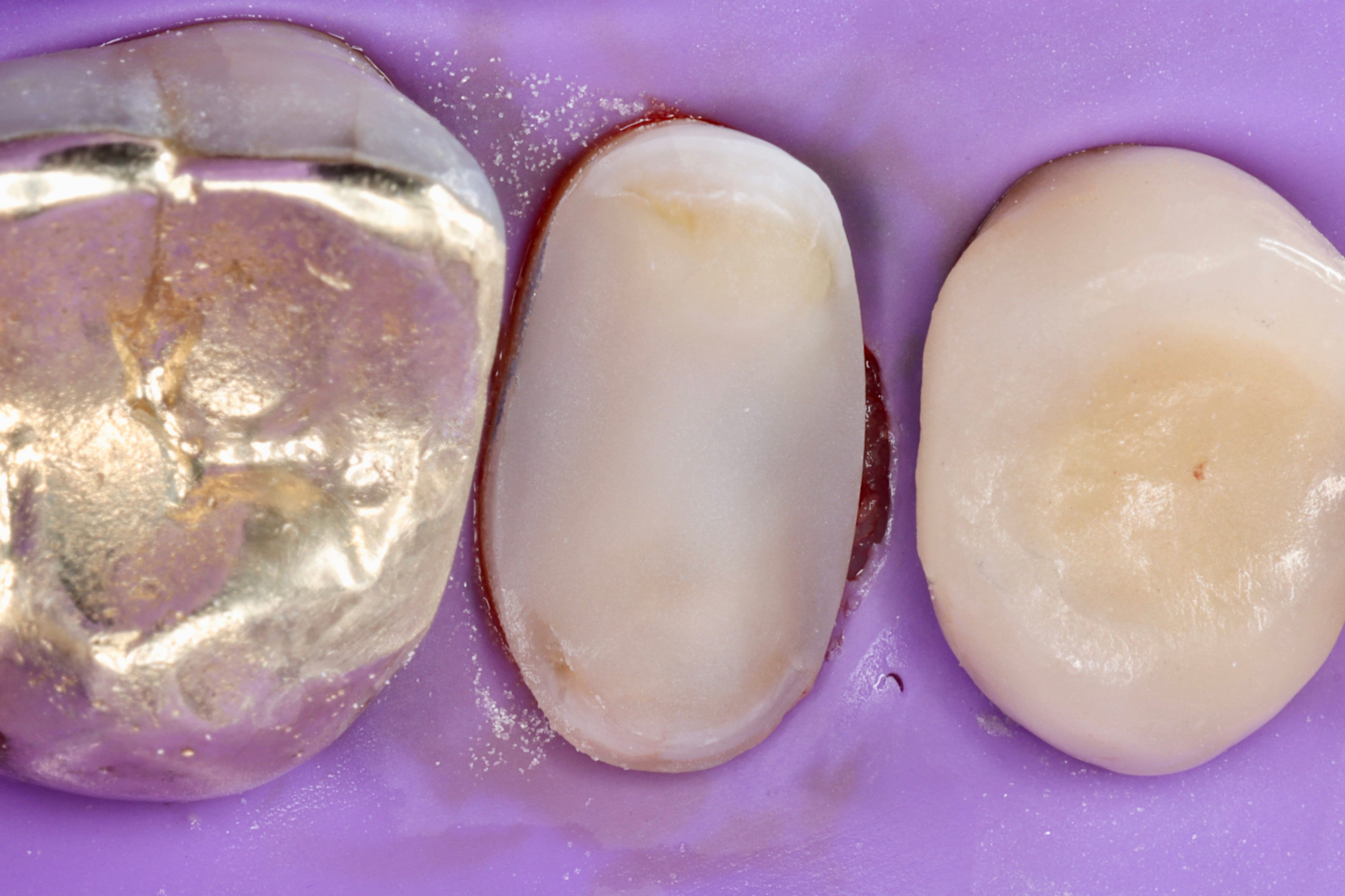 The "Liquid Dam" Technique - by Brandon Walker, D.D.S.