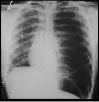 Pneumothorax in the ICU - by ... - PulmCCM