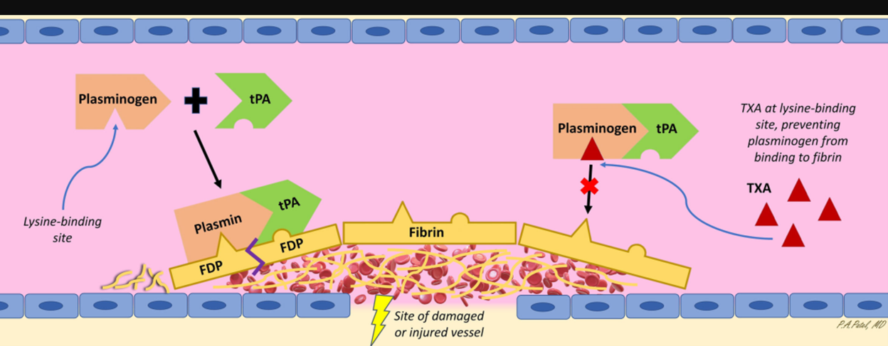 Patient Blood Management: The role of tranexamic acid (TXA)