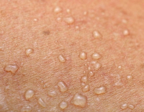 Dermatología: revisión bibliográfica acerca de enfermedades ampollosas ...
