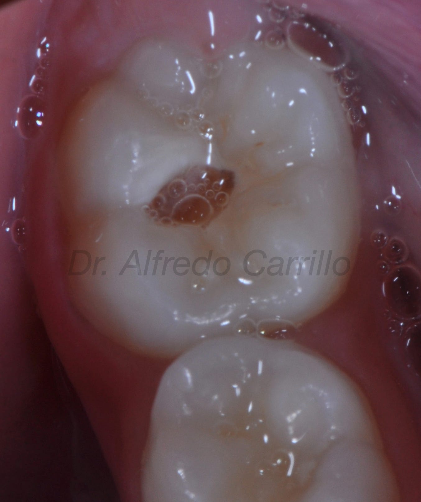 Comportamiento de una lesión cariosa - by Alfredo Carrillo