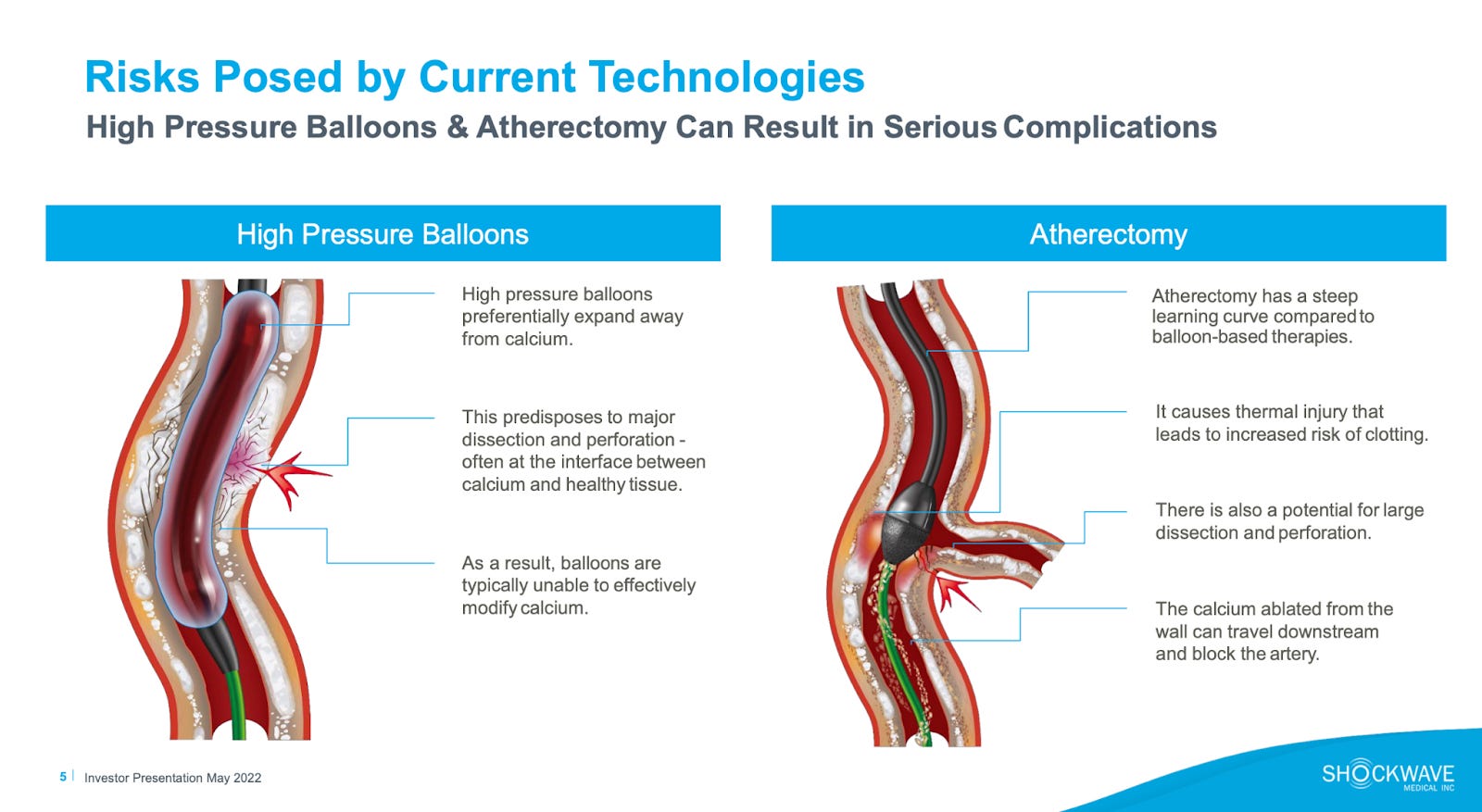 Deep dive on Shockwave Medical ($SWAV) - by Jonah Lupton