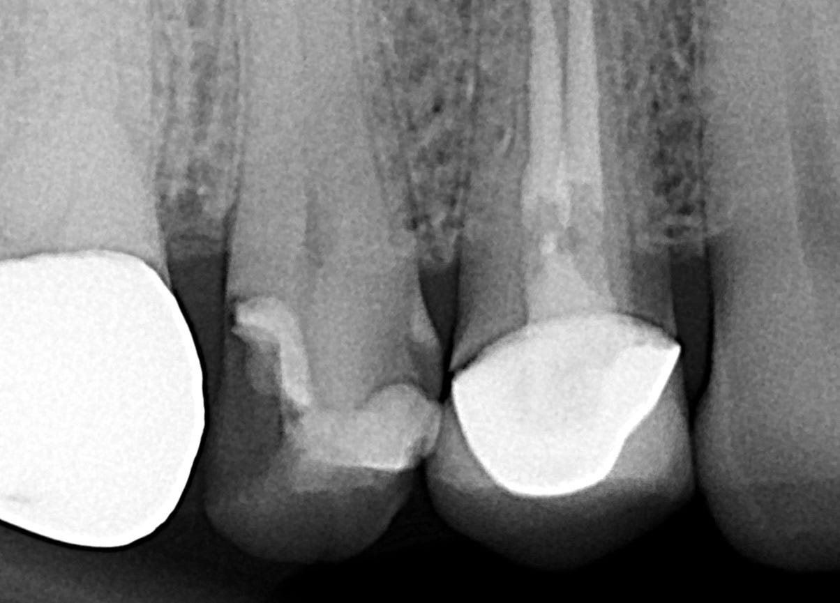 The "Liquid Dam" Technique - by Brandon Walker, D.D.S.