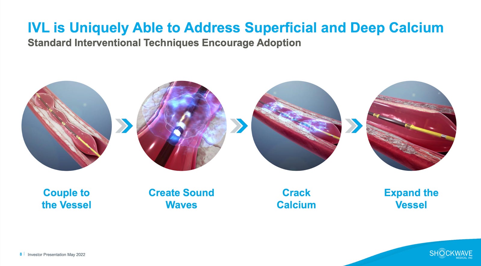 Deep dive on Shockwave Medical ($SWAV) - by Jonah Lupton