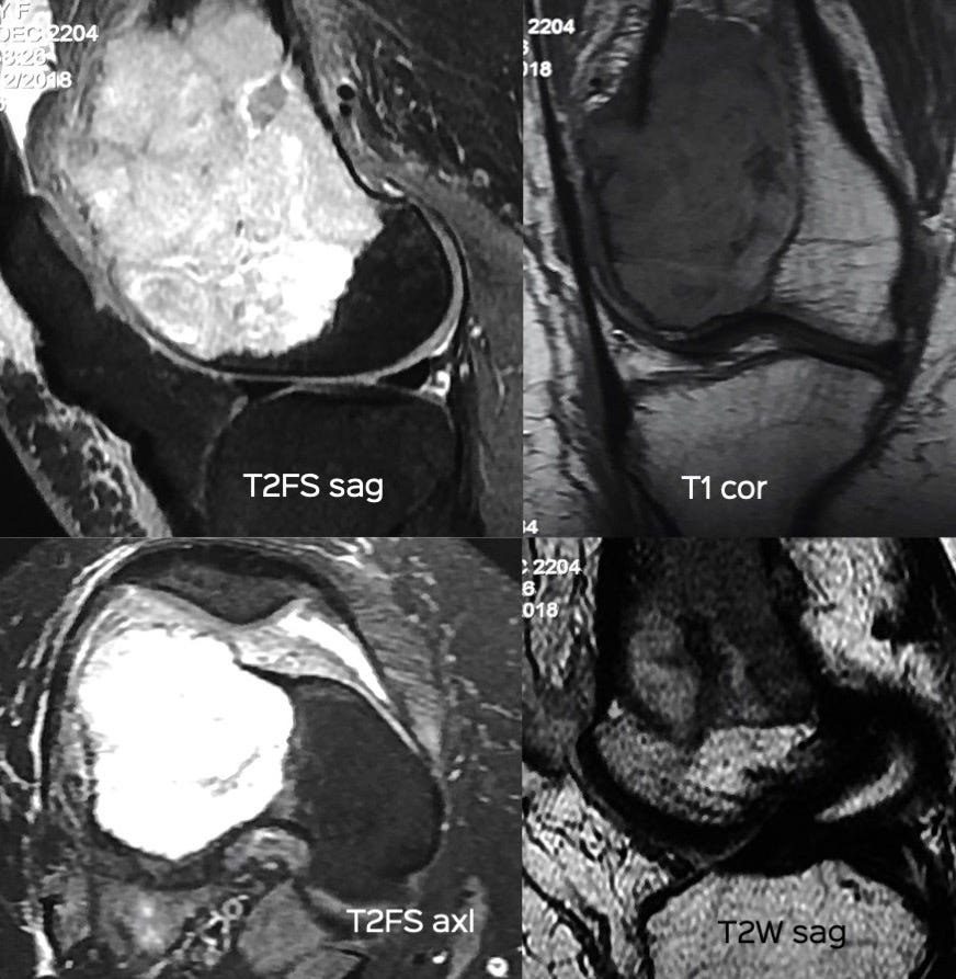 Case 12: Typical Distal Femur Lesion - by Bhavin Jankharia