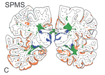 Multiple sclerosis with a near-normal MRI