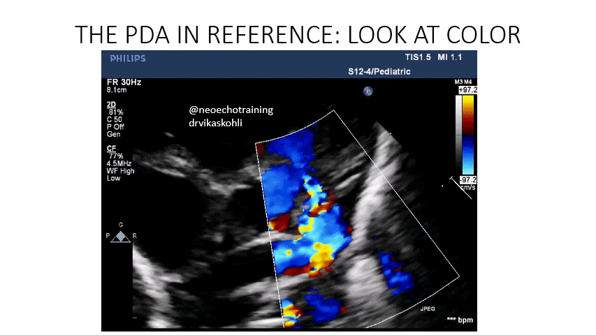 PDA SIZE MEASUREMENT - by Vikas Kohli