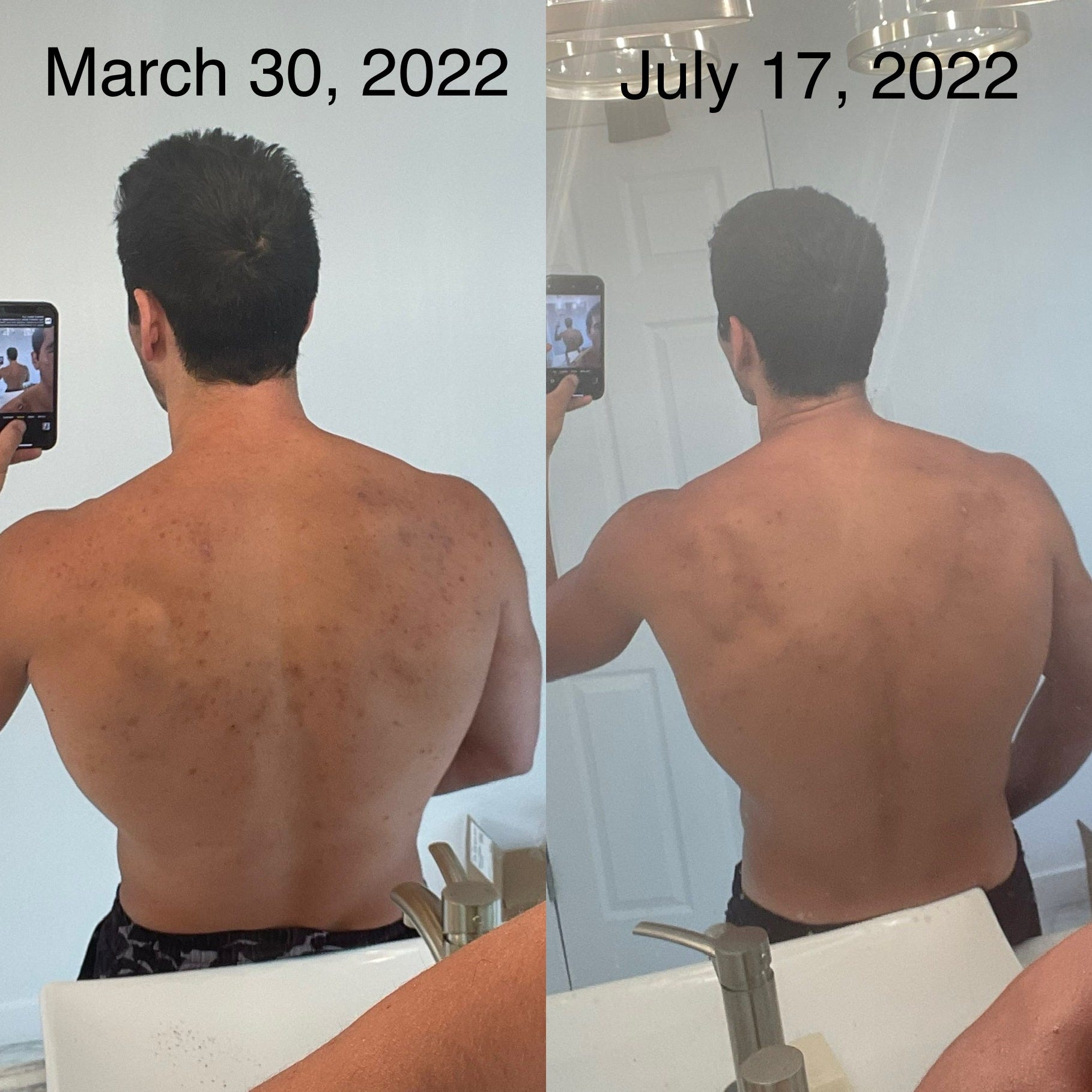 Clearing Back Acne and Hyperpigmentation - by Fawn B.