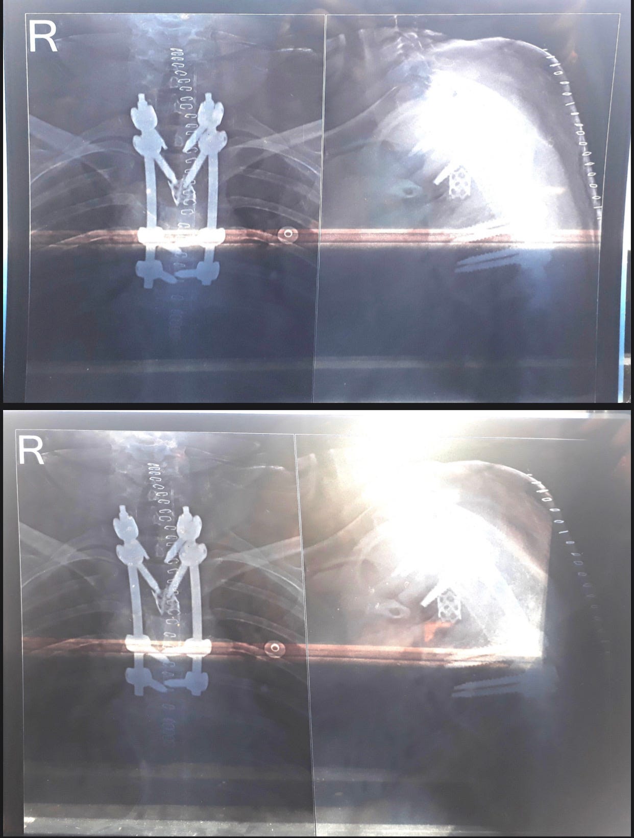 The journey from MMT grade 0 to grade 4