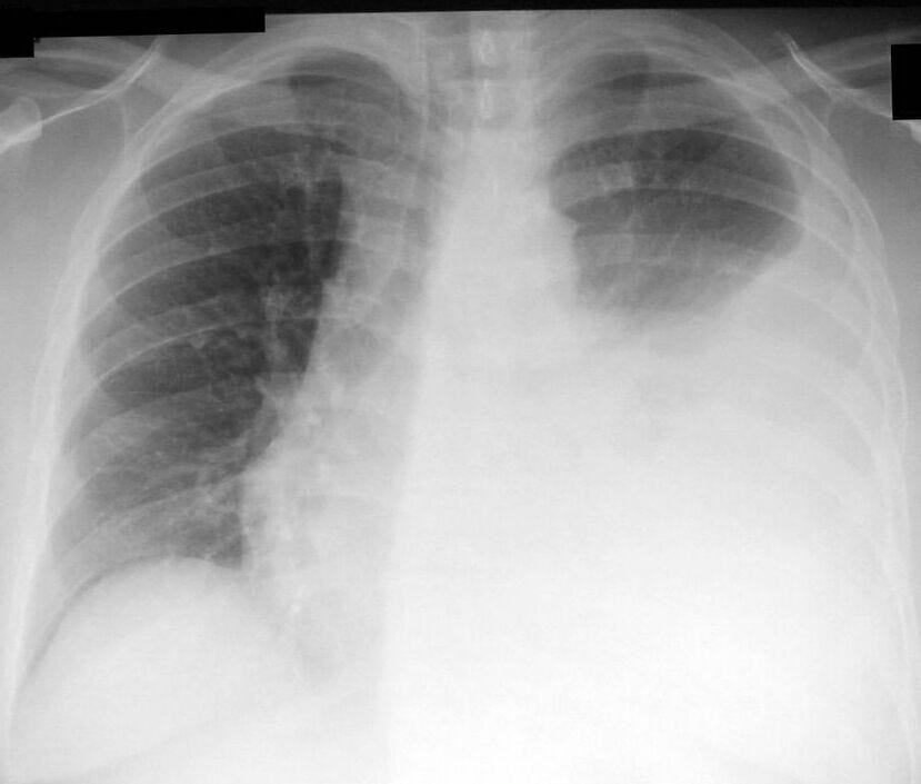 Pleural catheters equal to pleurodesis for dyspnea relief from ...