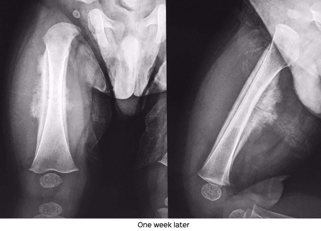 Case 20: A Scary Femur - by Bhavin Jankharia