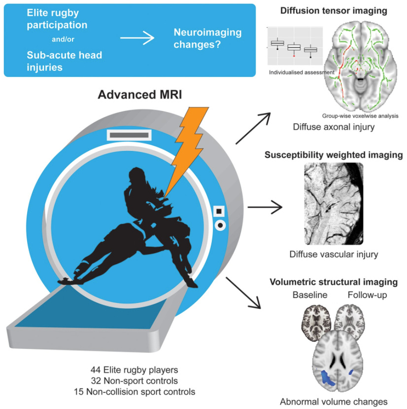 Preventable Traumatic Brain Injury in Rugby Players