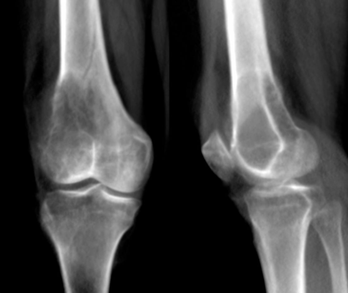 Case 12: Typical Distal Femur Lesion - by Bhavin Jankharia