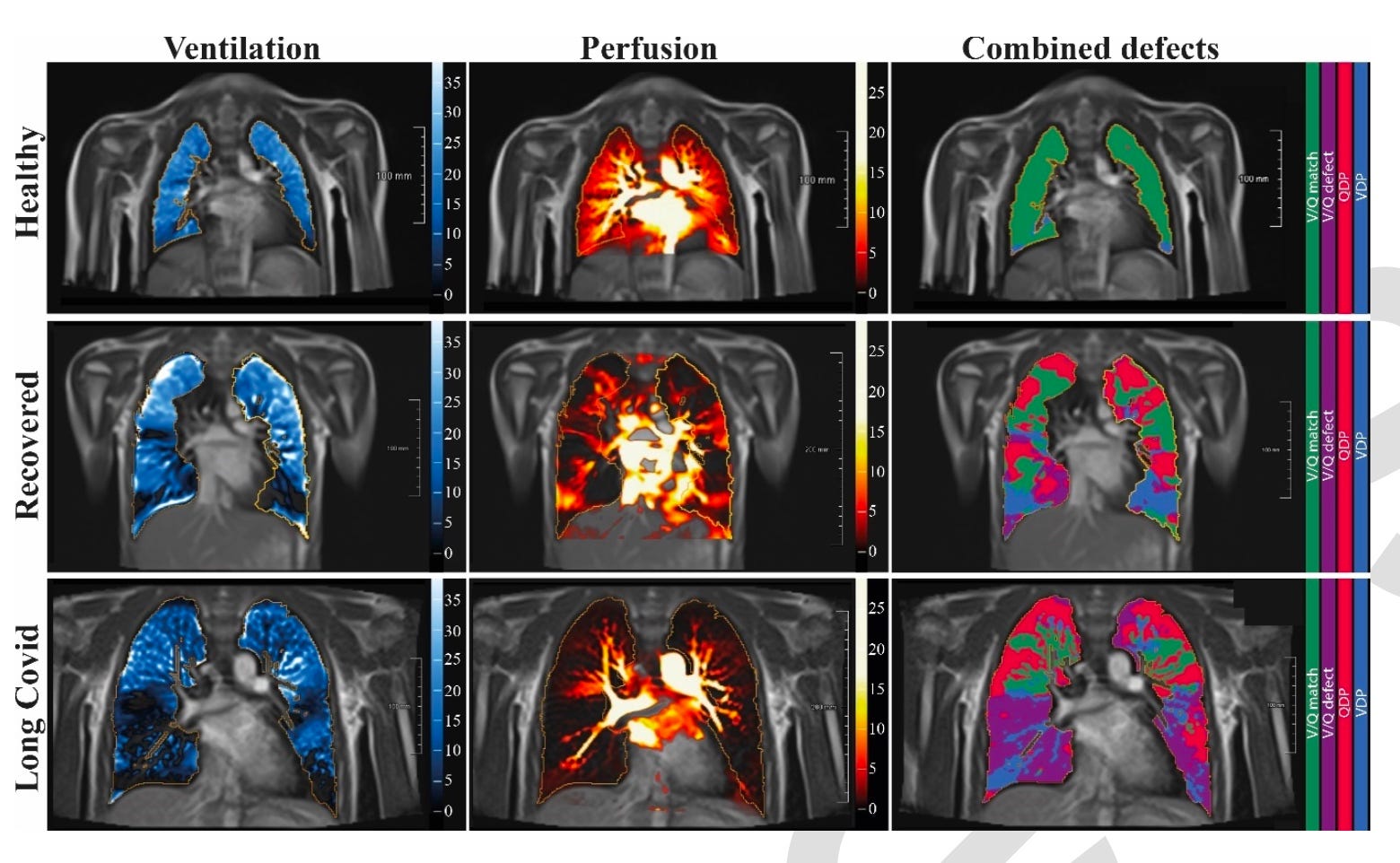 The Virus Shuts Down Kids' Lungs Study - by Brian Mowrey