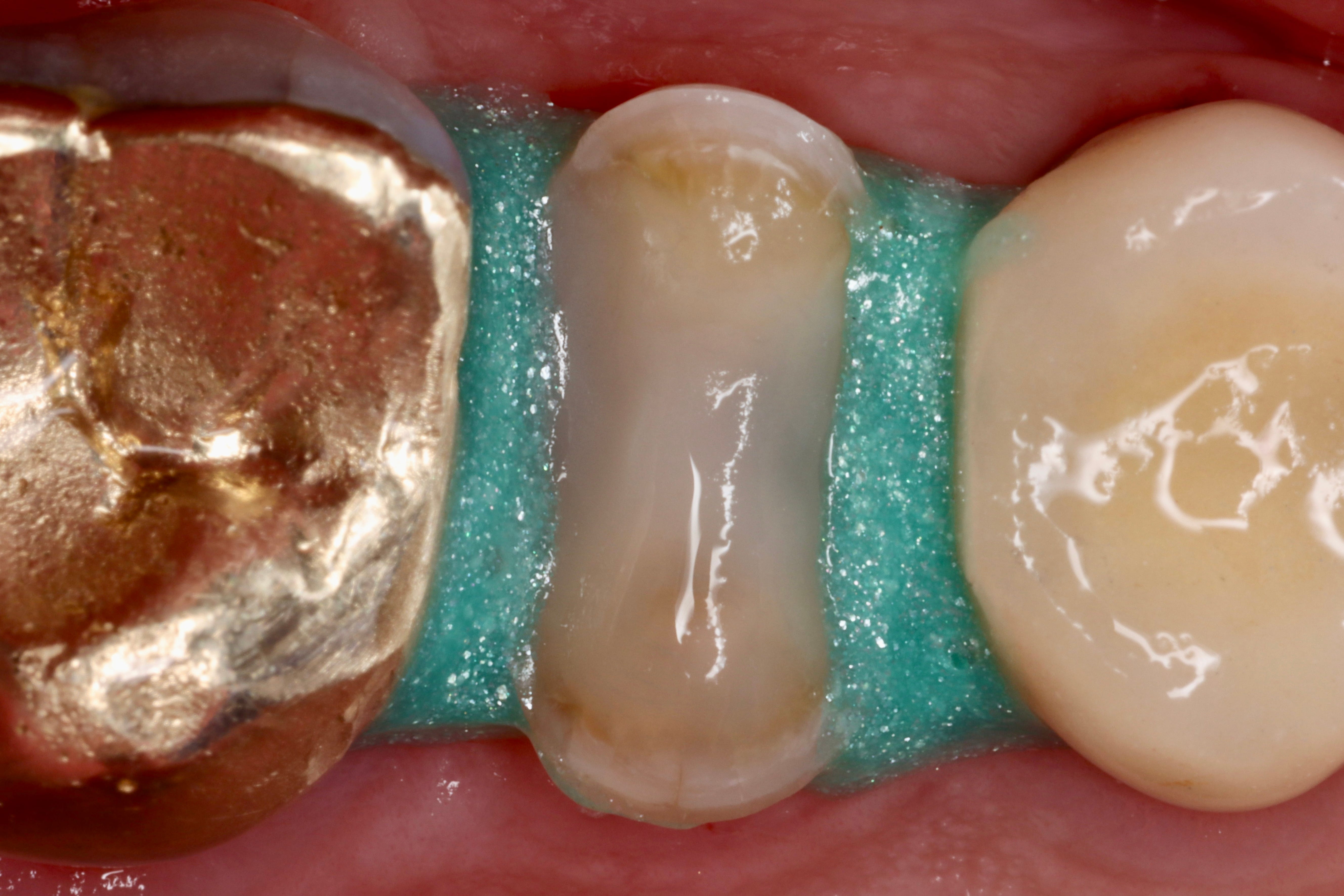 The "Liquid Dam" Technique - by Brandon Walker, D.D.S.