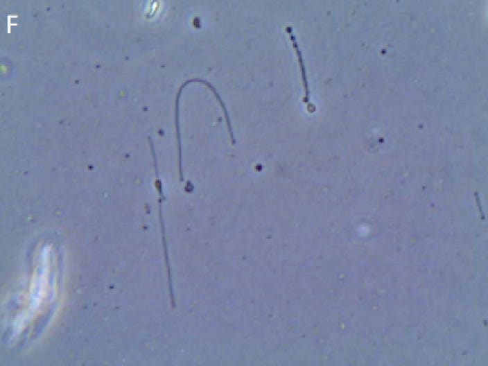 Extensive (CDB) Hydrogel Filament Growth In C19 Vaccinated and ...