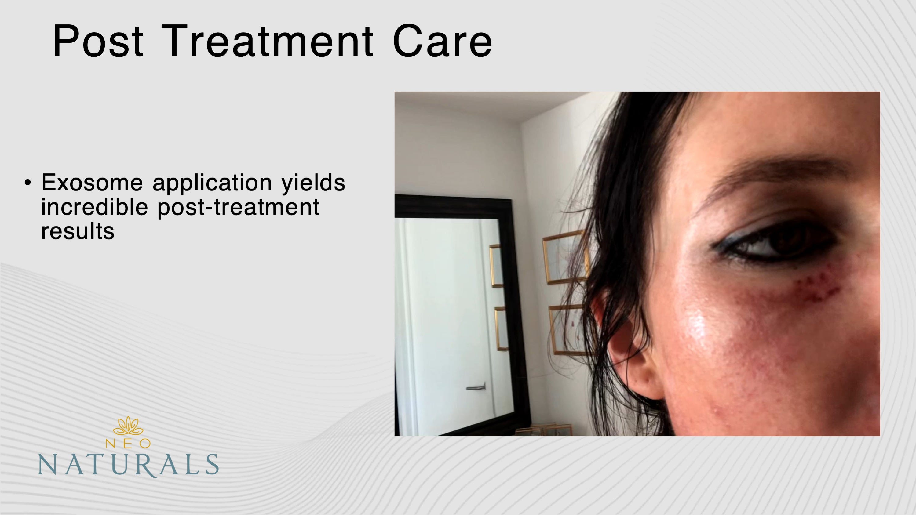 NEO Naturals Exosomes for Cosmetic Gynecology and Aesthetics