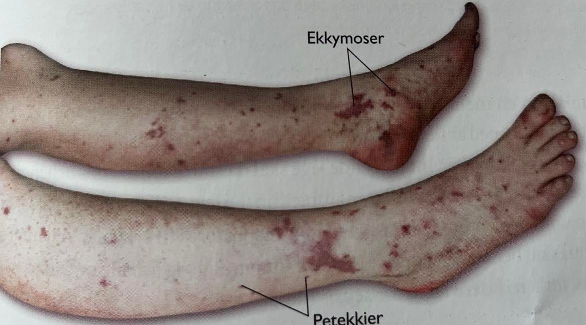 Meningitas ir pacientų slauga | Slaugytojams
