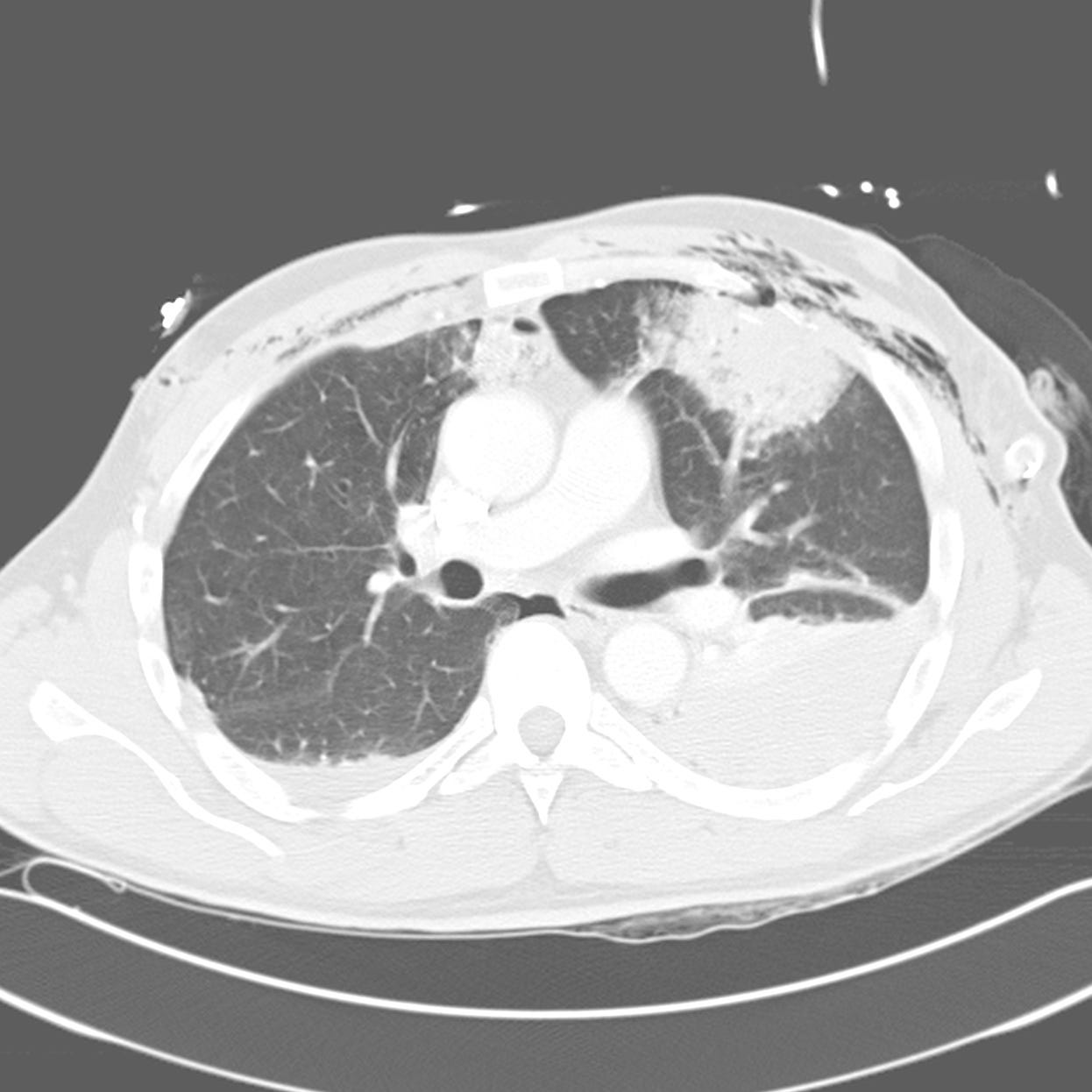Pulmonary Contusions and Lacerations - by Alexander Baxter