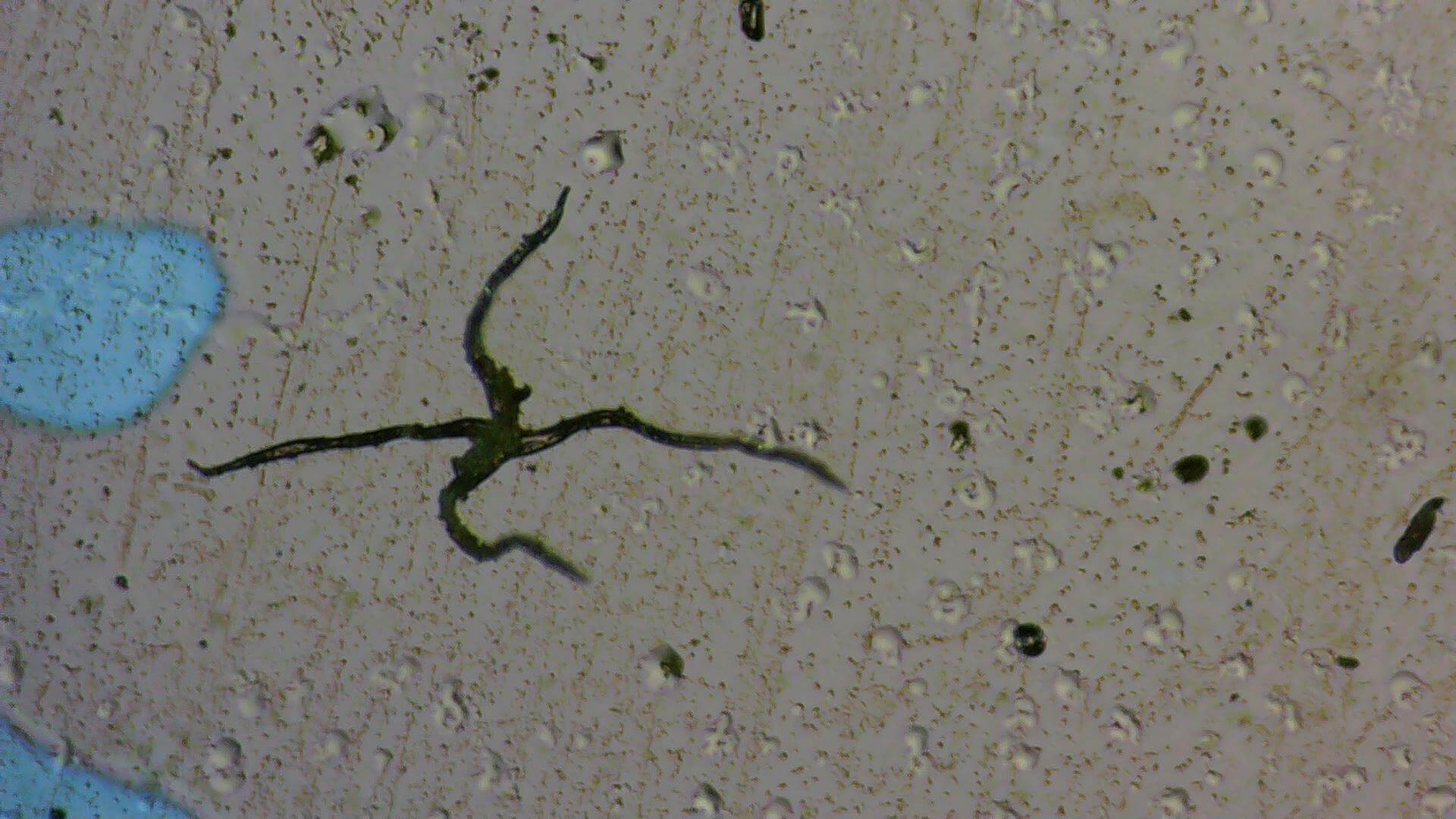 Morgellons Like Filament Tumor Found In Nasal Cavity With Insect ...