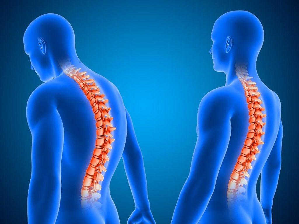 Hyperkyphosis: Types and Implications