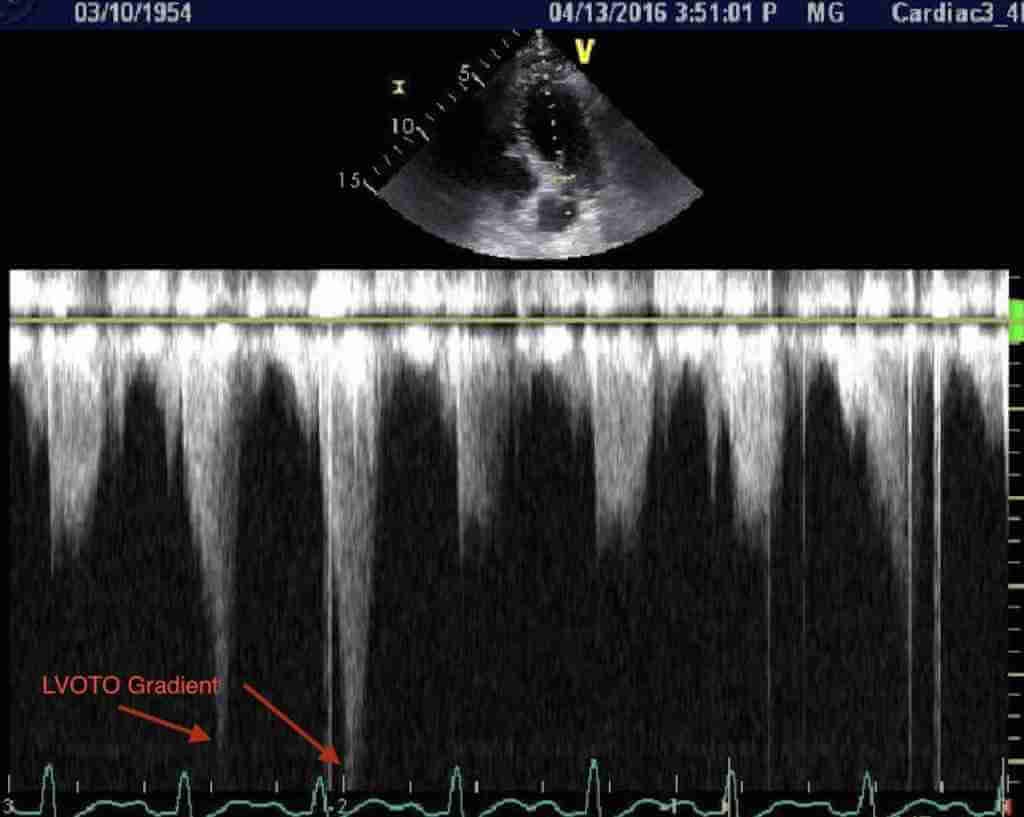 How I Self-Diagnosed and Treated My Hypertrophic Cardiomyopathy