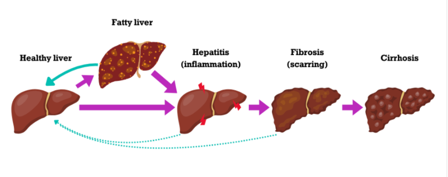 Fatty Liver...how to reverse it - Dr Arif Hussenbux