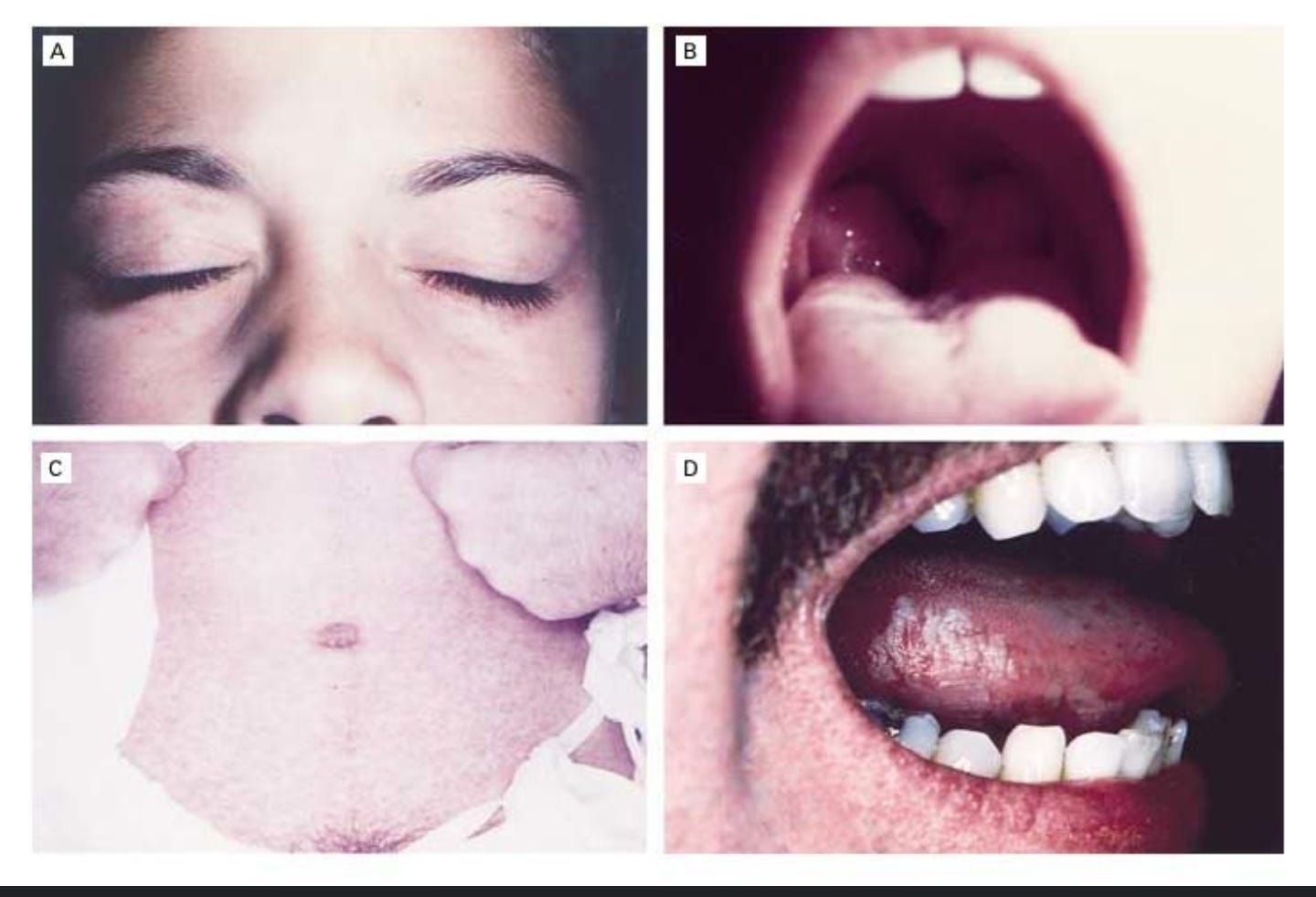 Unraveling the Hidden Impact of Epstein-Barr Virus: From Mononucleosis ...