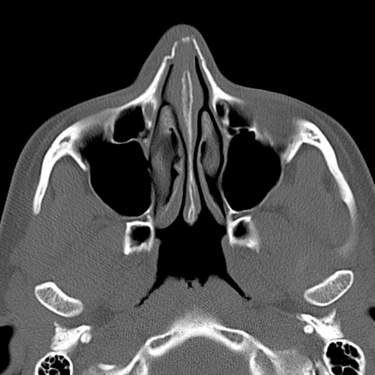Nasal and Naso-orbito-ethmoid Fractures