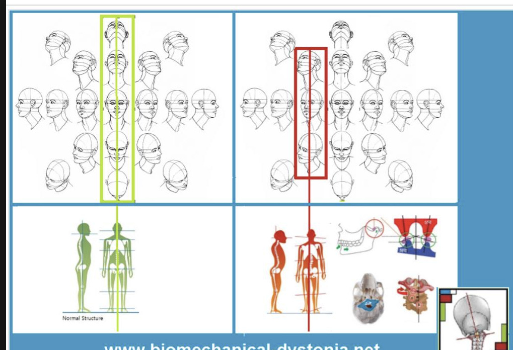Indexed splints and the magical "perfect jaw position"