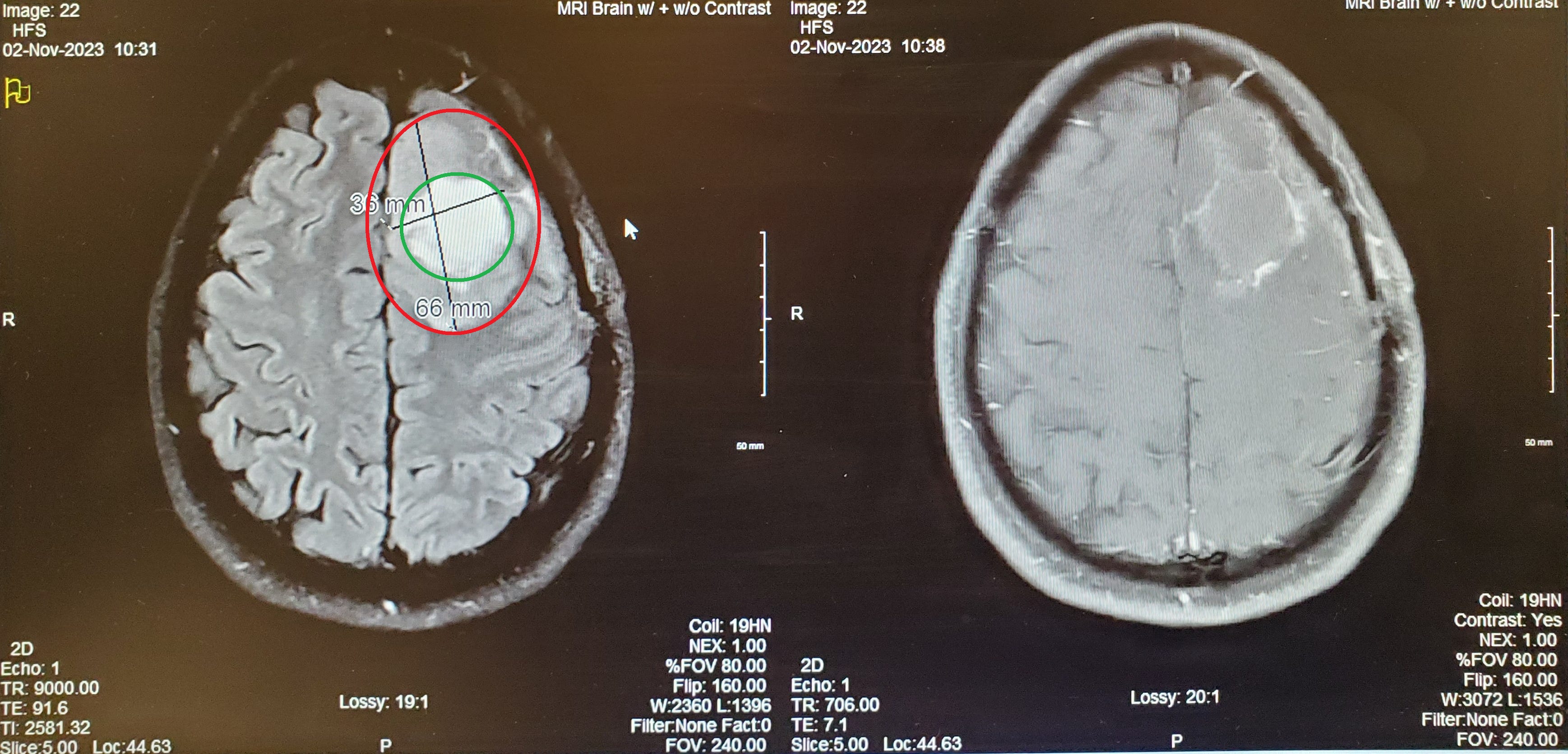 All MRI scans as of 05/17/2024: (Updated on 05/22/2024 with new pictures)
