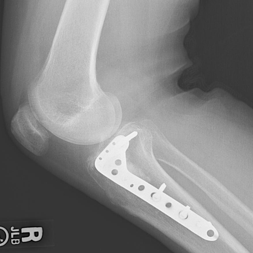Orthopedic Hardware - Part 1 - by Alexander Baxter