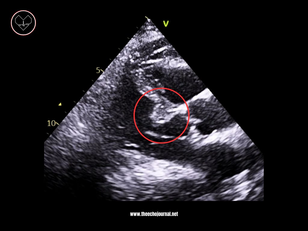 What is a Sigmoid Septum? - The Echo Journal
